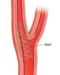 Carotid Stenting | NCH Healthcare System