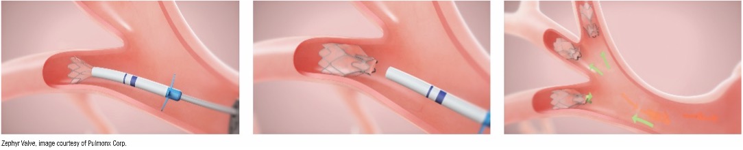 PulmonX | NCH Healthcare System